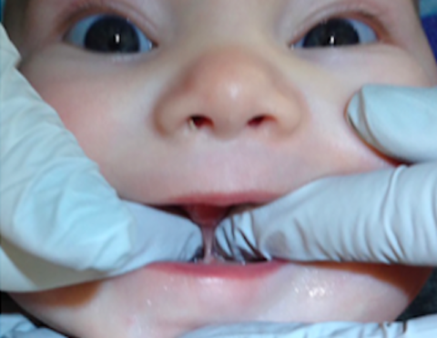 Lingual Frenulum Assessment in Newborns: A Comprehensive Approach ...